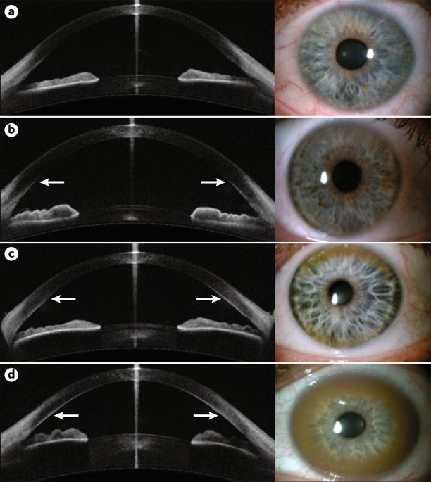 Kayser Fleischer Ring