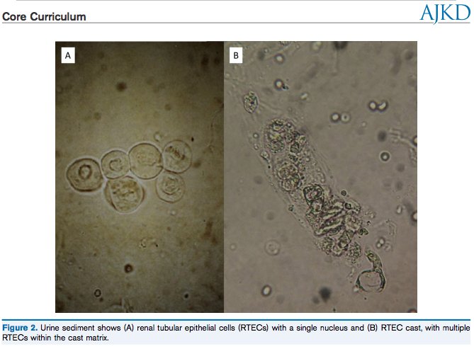 Transitional Renal Epithelial Cells In Urine