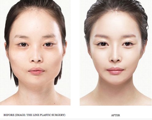 Korean Permanent Smile