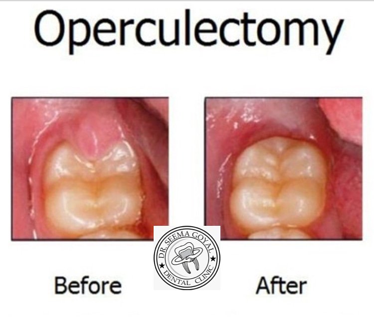 Operculectomy