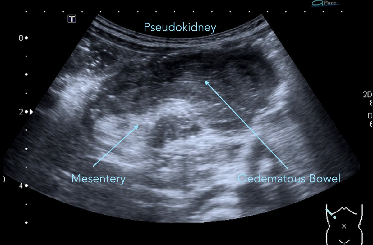 Pseudokidney Sign