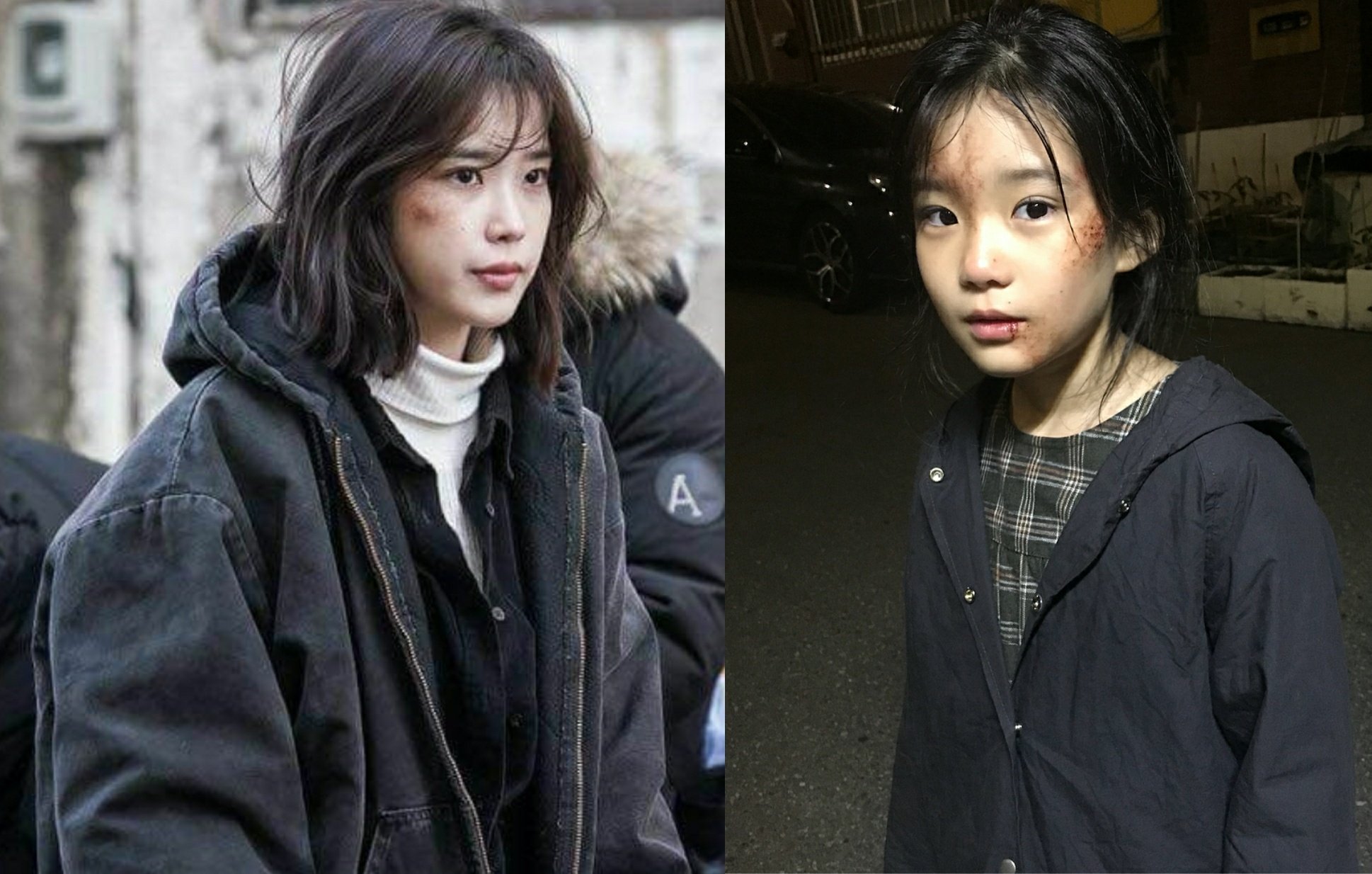 Iu Plastic Surgery Before And After