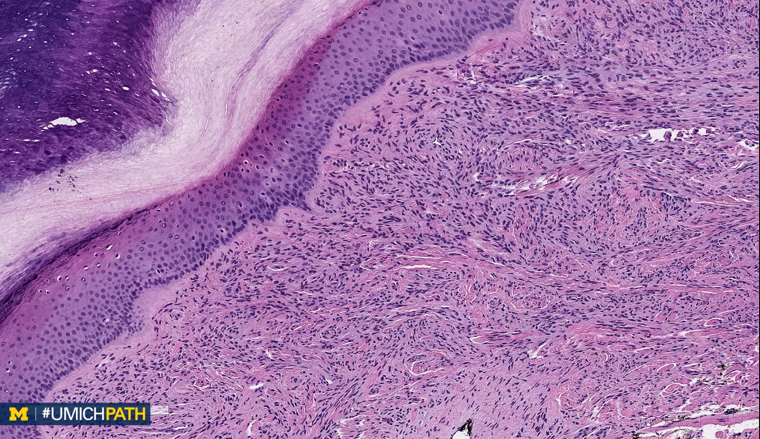 Giant Cell Fibroma Histology Fibrous, Gingival, Lipocytic, And