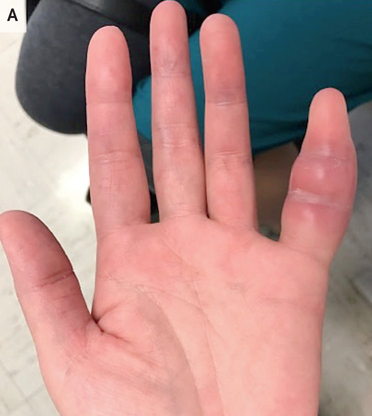 Septic Arthritis Finger