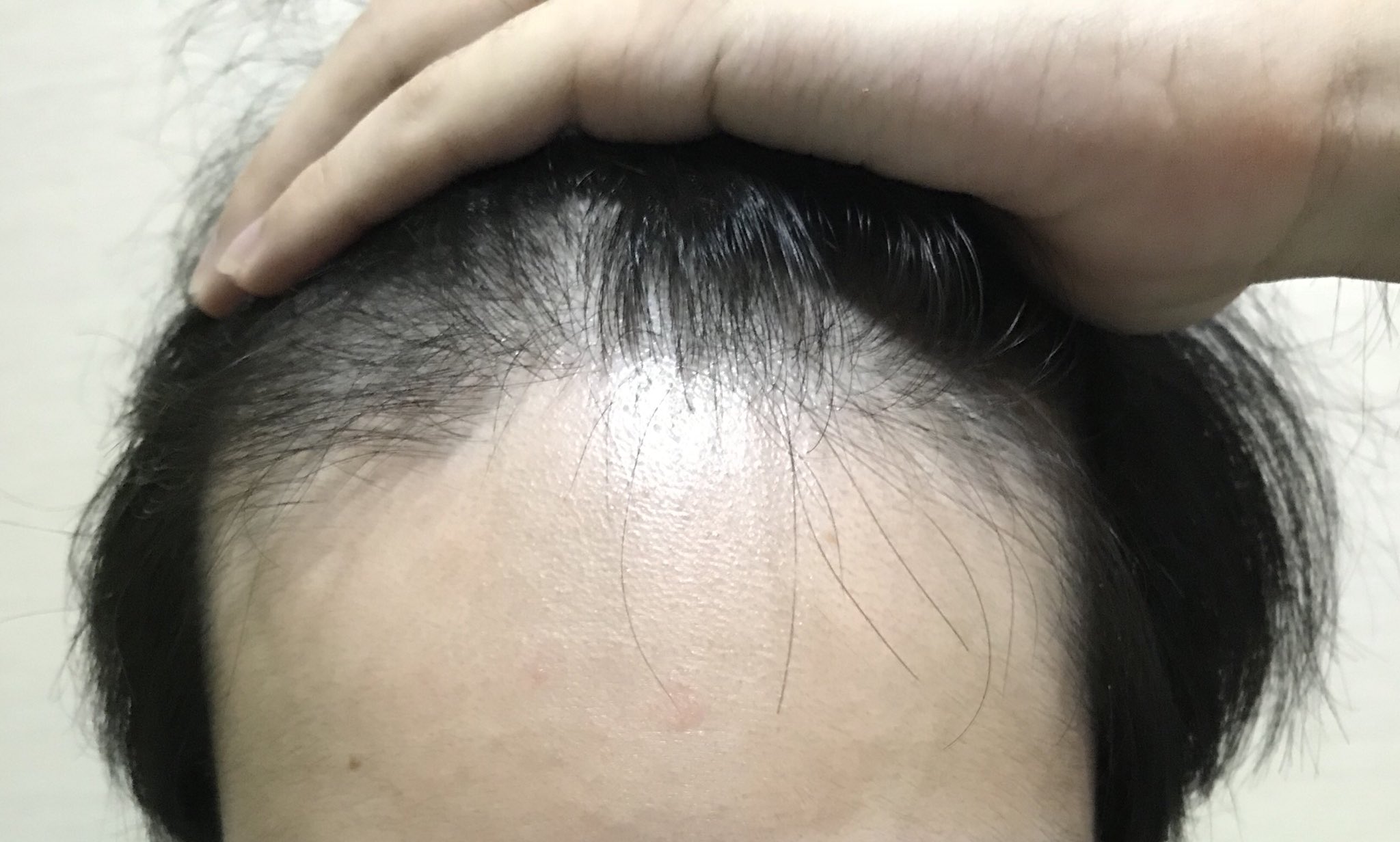 レアチーズアニキ🍰 on Twitter: "【治療1ヶ月目】 ・プロペシア 1mg ・ミノキシジルタブレット 2.5mg ・亜鉛 10mg ・フォリックスFR15 #AGA #ハゲ #若ハゲ ...