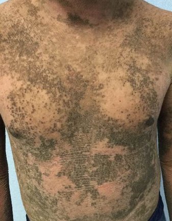 Congenital Ichthyosiform Erythroderma