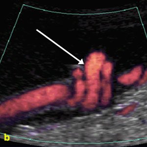False Knot Umbilical Cord