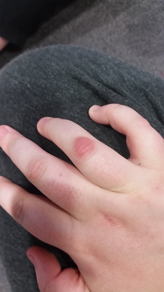 Female Bruised Knuckles