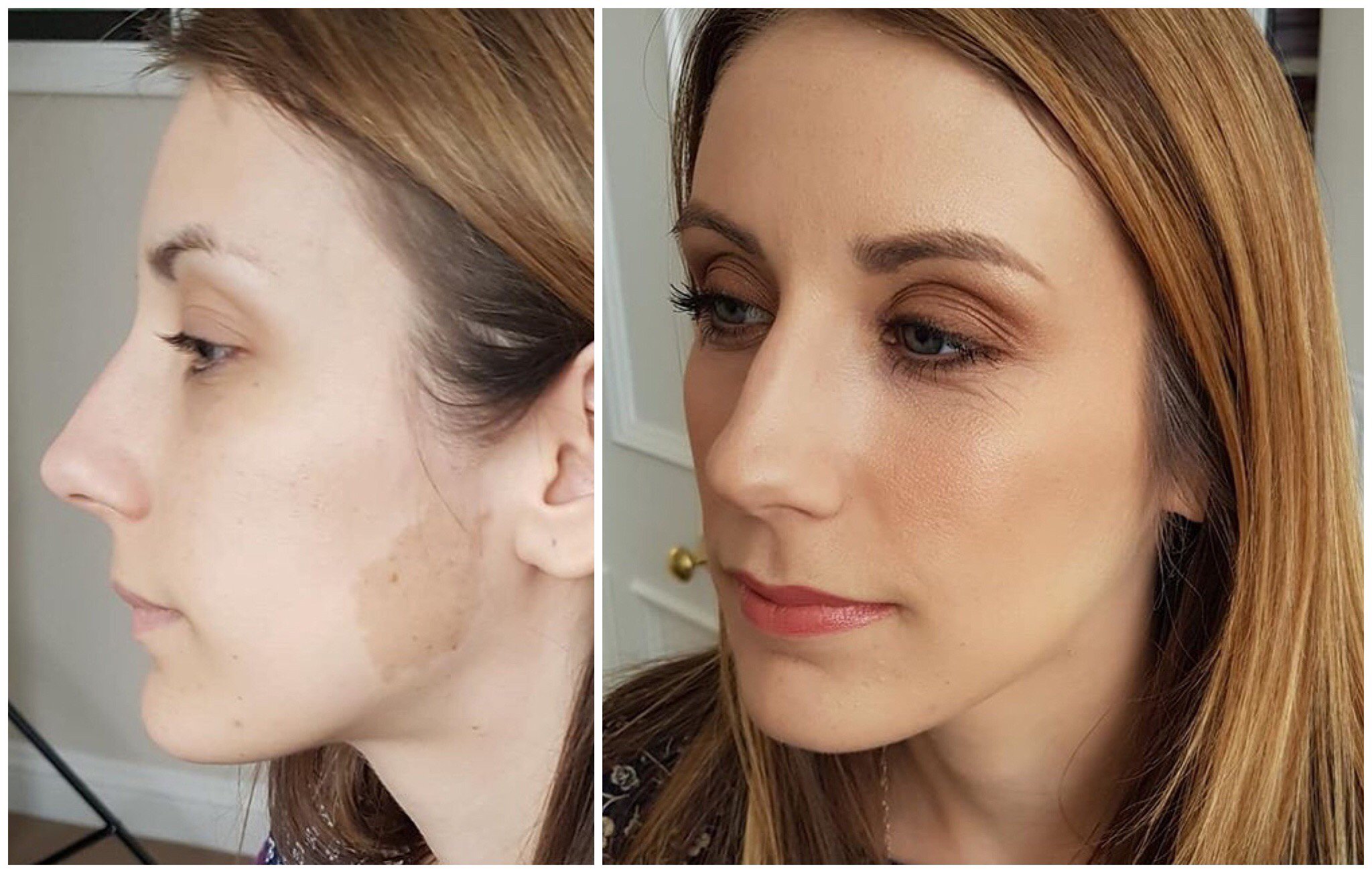 Cafe Au Lait Spots On Face