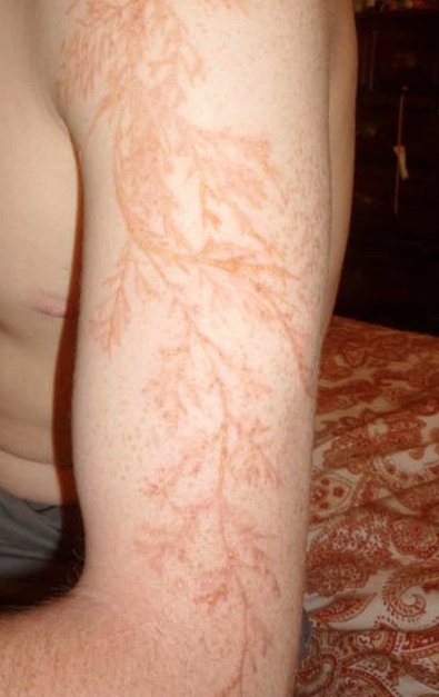Lightning Scars On People