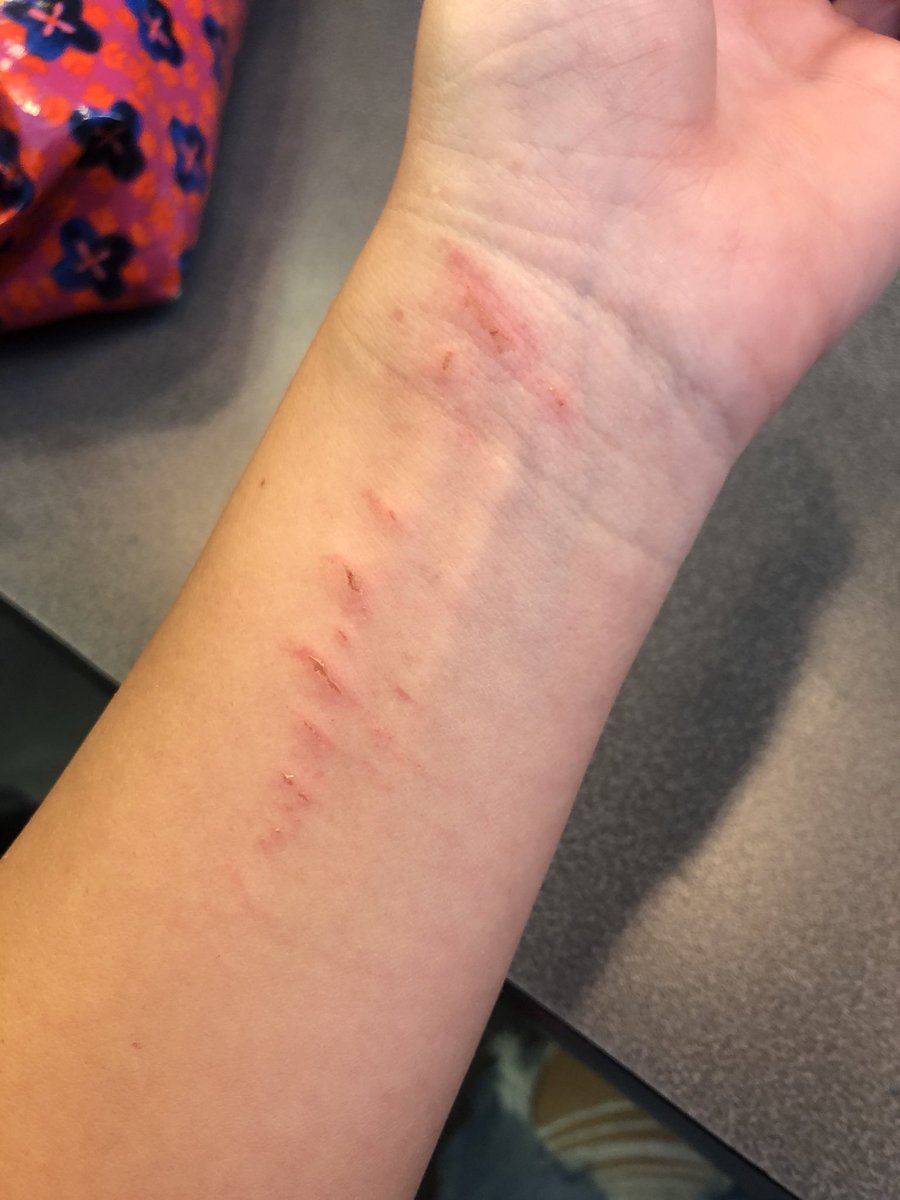 Bad Cuts On Wrist