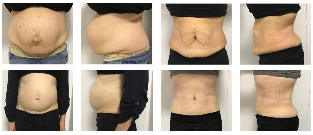 Belly Button Outie After Pregnancy