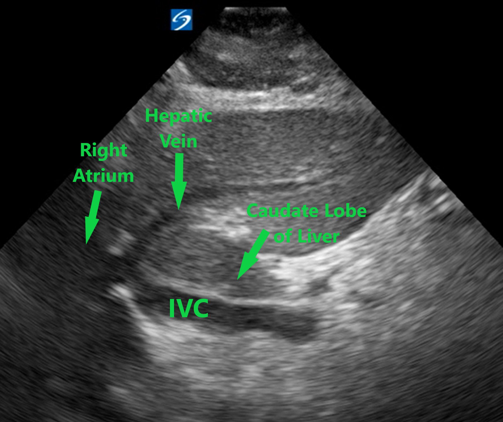 Caudate Lobe Of Liver Ultrasound
