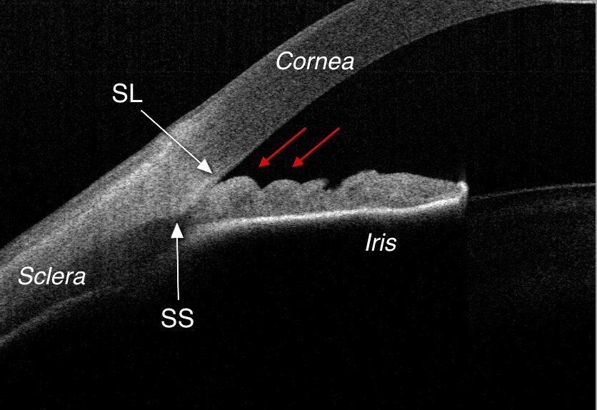 Slt Angle For Anatomy
