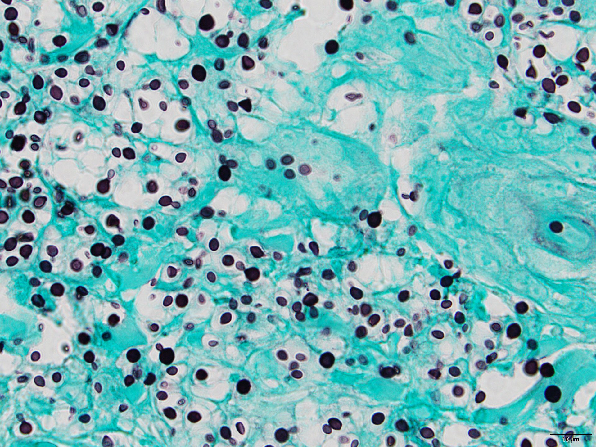Cryptococcus Neoformans Mucicarmine Stain