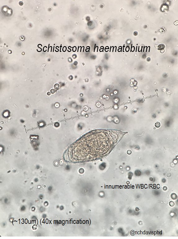 Schistosoma Haematobium In Urine