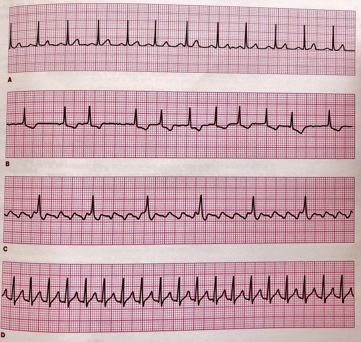 Notas De Medicina Familiar Ecg Flutter Auricular - vrogue.co Notas De Medicina Familiar Ecg Flutter Auricular - vrogue.co