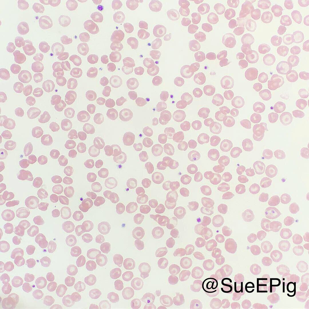 Hemoglobin C Crystals