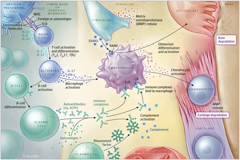 Pathophysiology Of Rheumatoid Arthritis Diagram