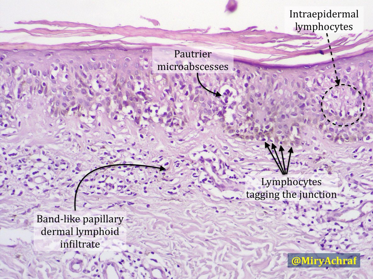 Mycosis Fungoides Histology