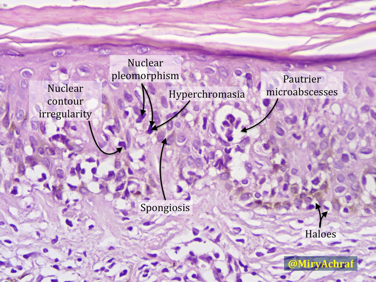 Pautrier Microabscesses