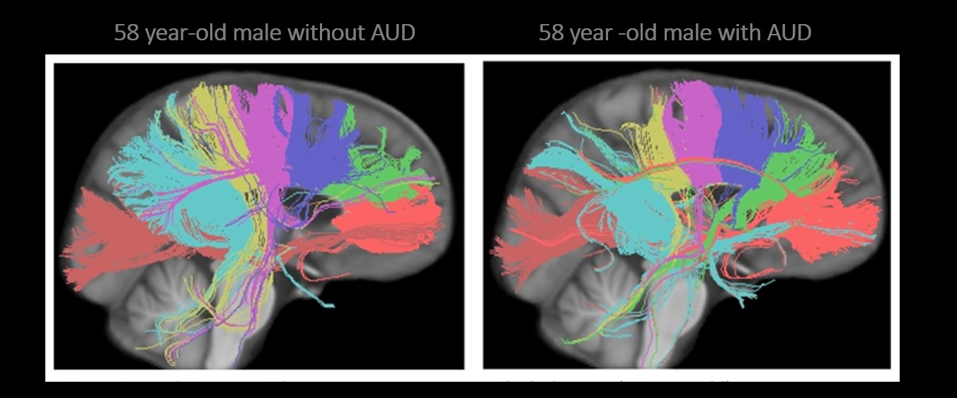 Diseased Brain Alcohol