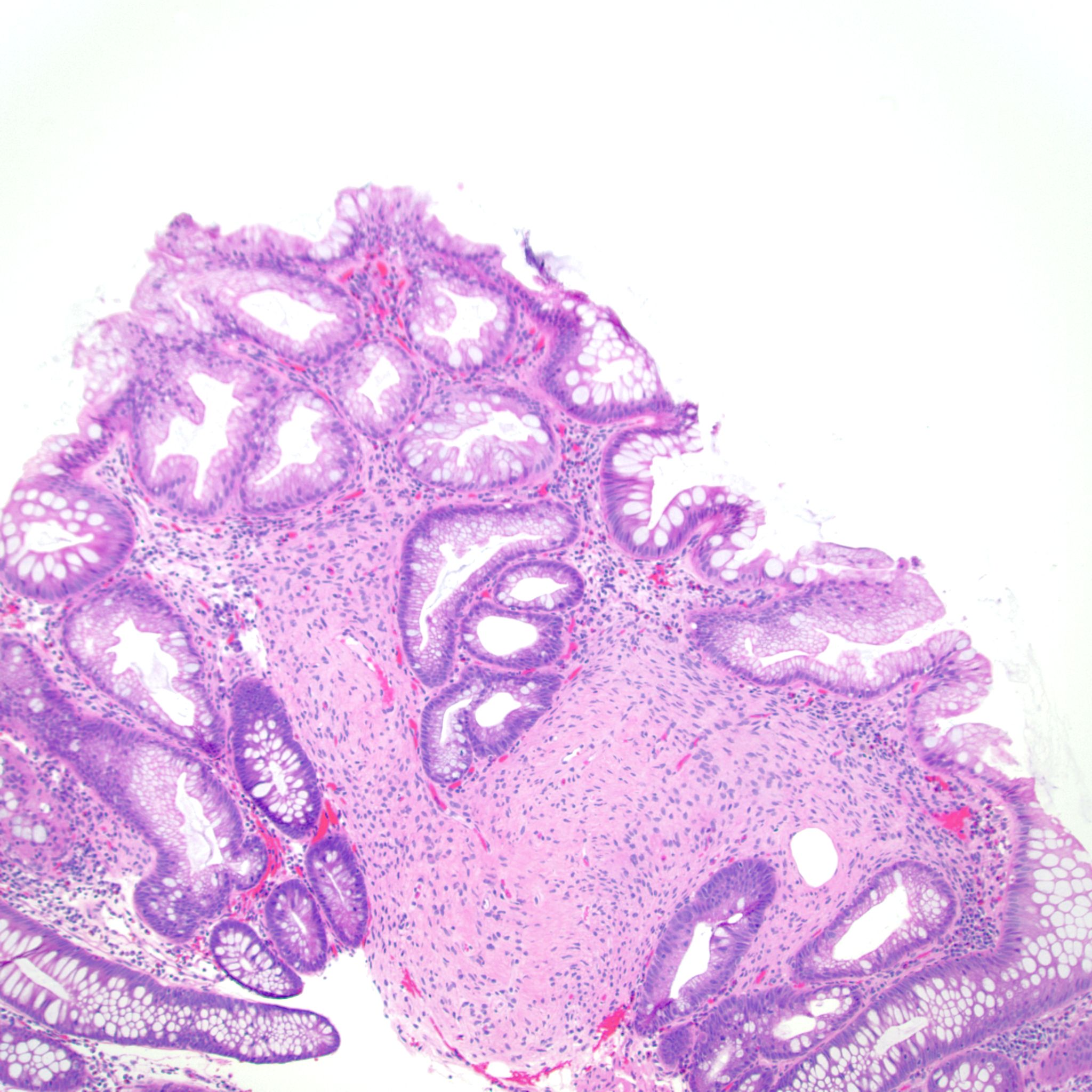 Sessile Polyp Histology