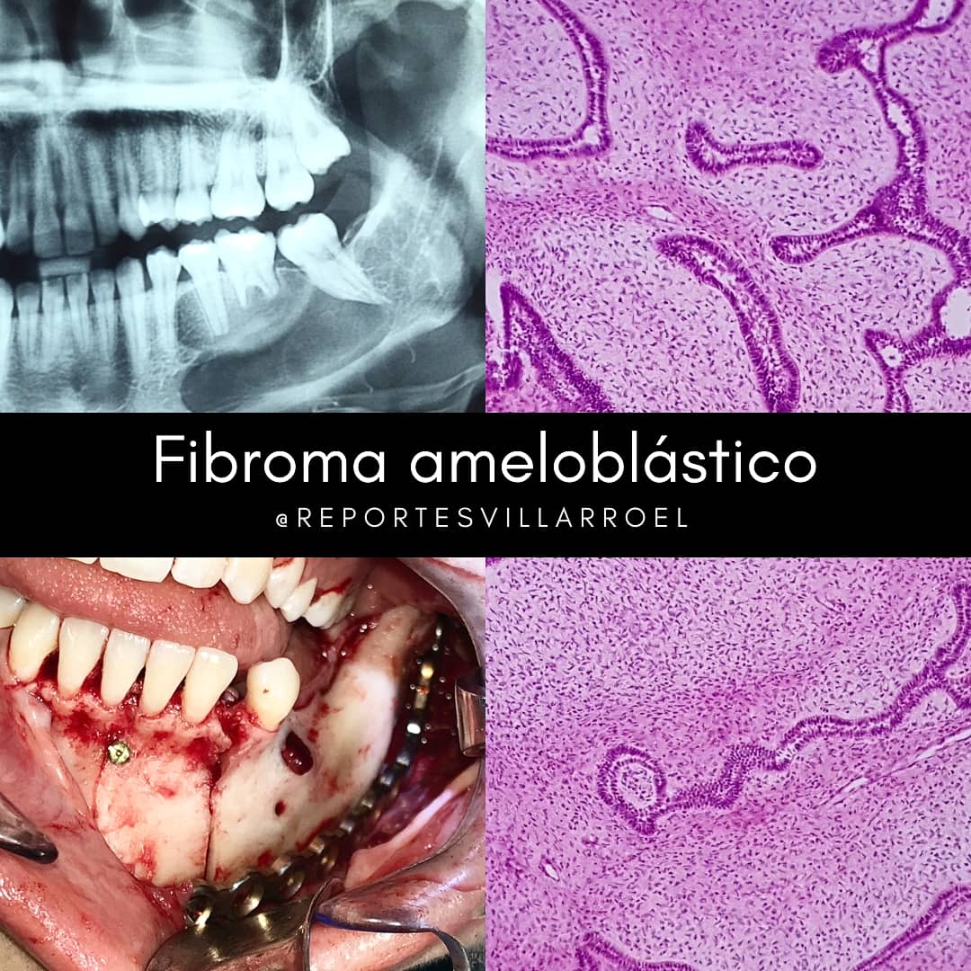 Ameloblastic Fibroma