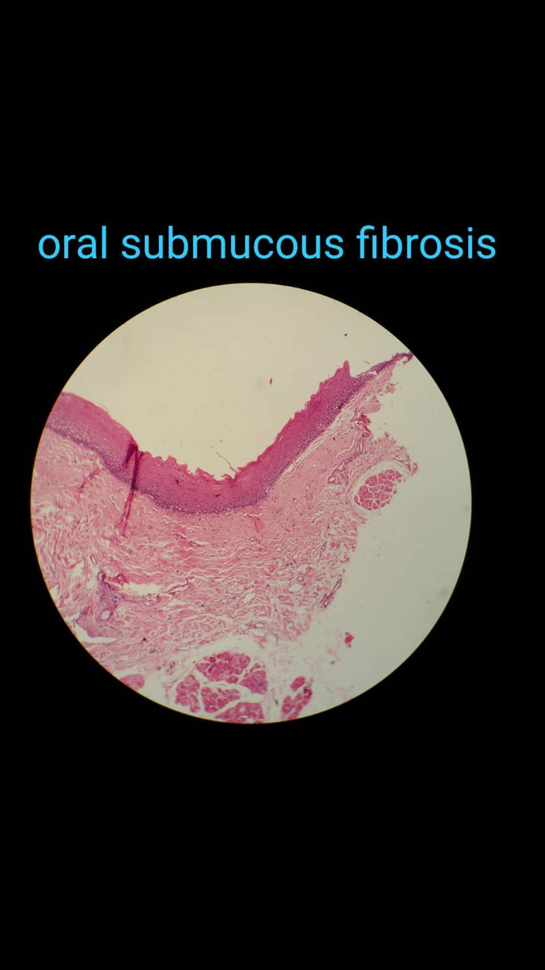 Oral Submucous Fibrosis Histology