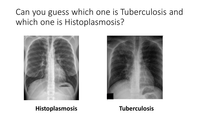 Histoplasmosis Lung X Ray