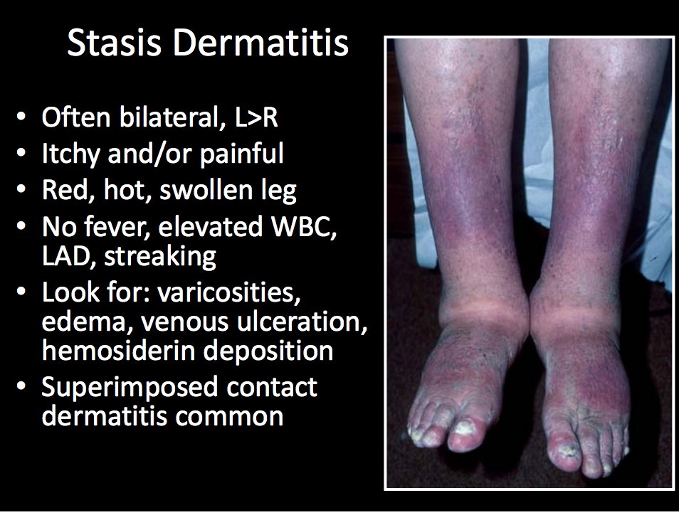 Venous Stasis Dermatitis Cellulitis