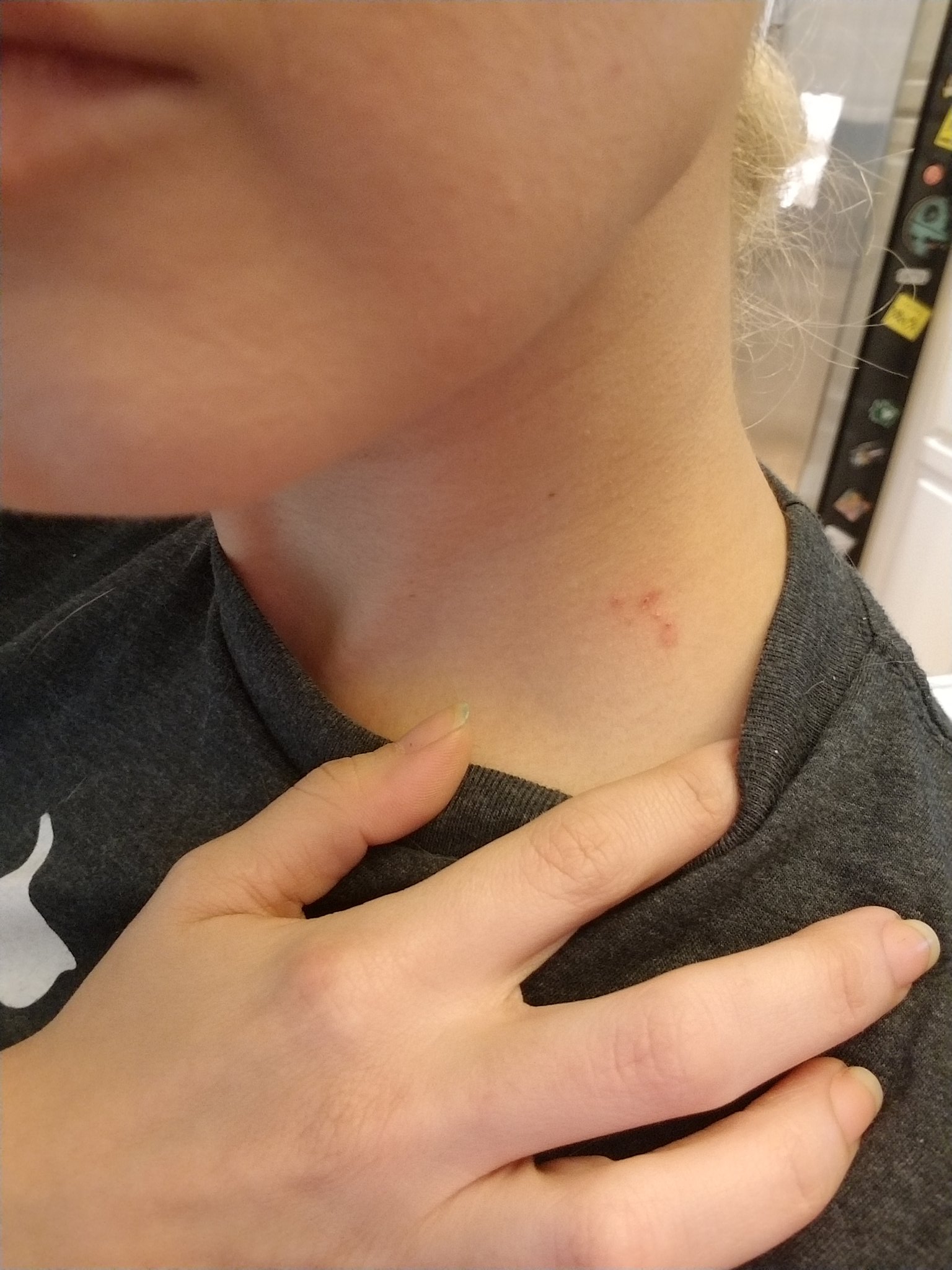 Vampire Bite Marks On Neck