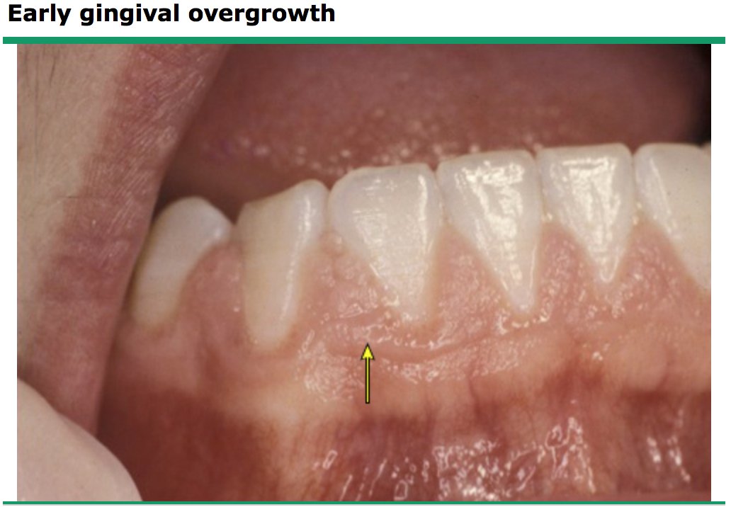 Papillary Gingiva