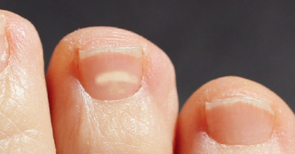 Healthy Toenail Color