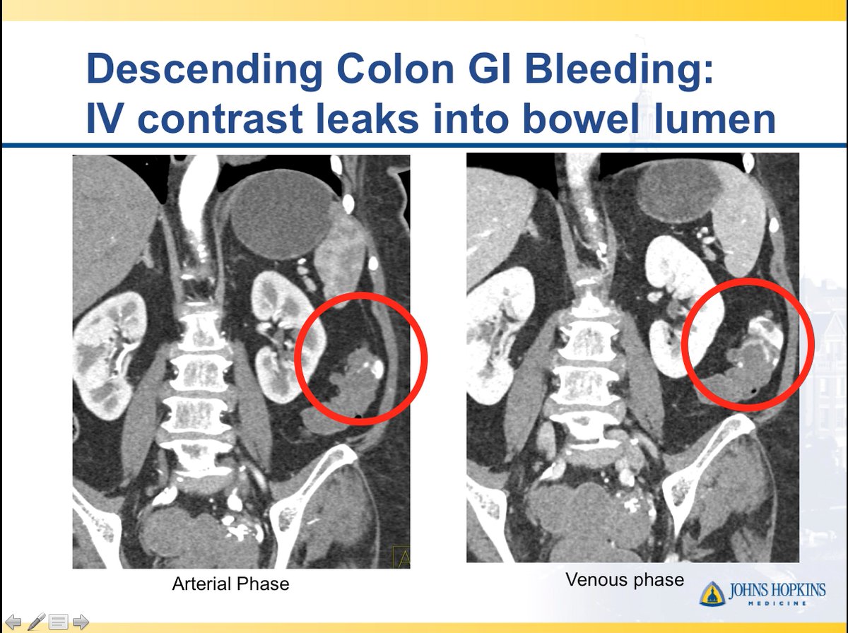 More high value radiology! Topic: PO contrast for abdominal & pelvic CT ...