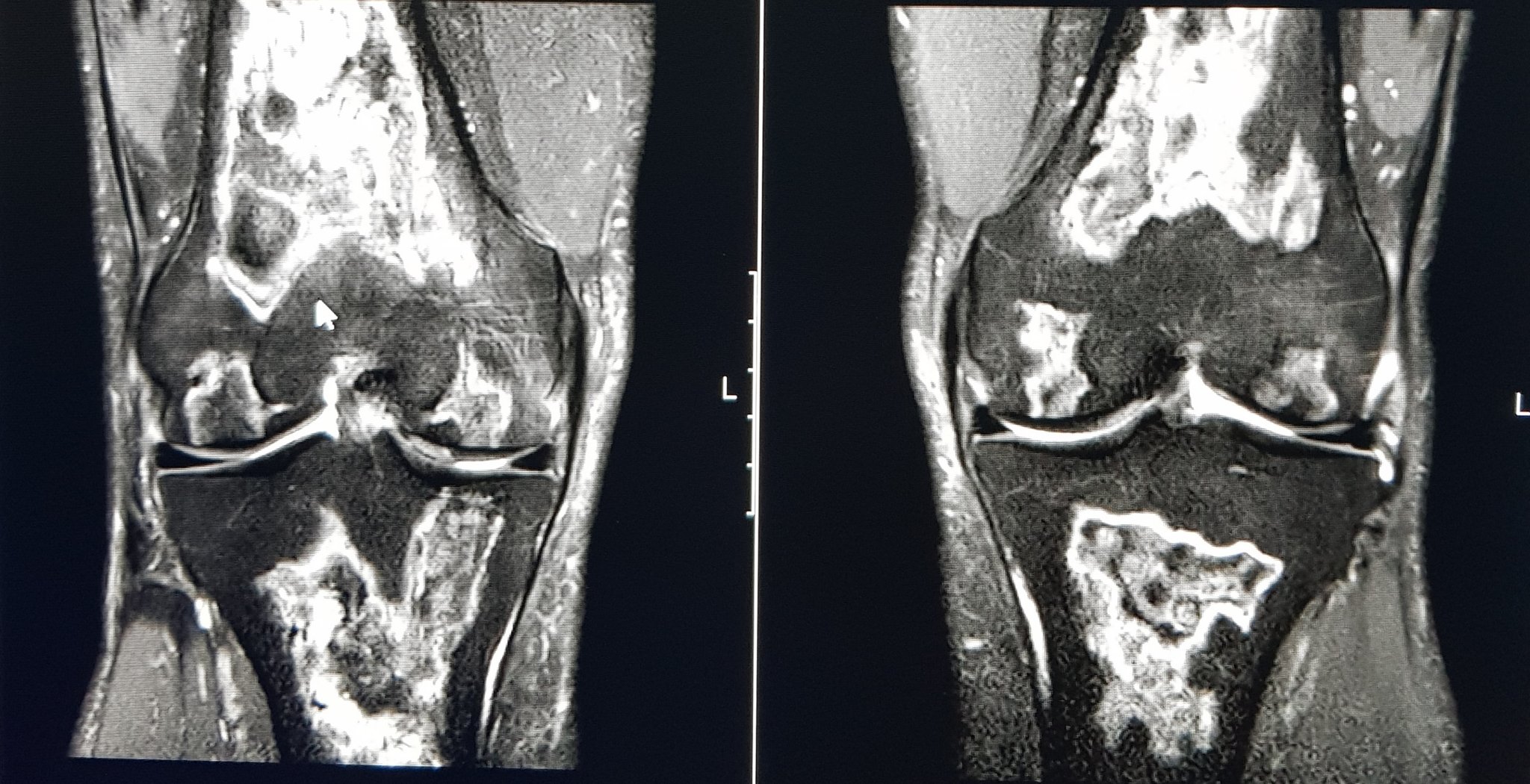 Osteonecrosis Of The Knee