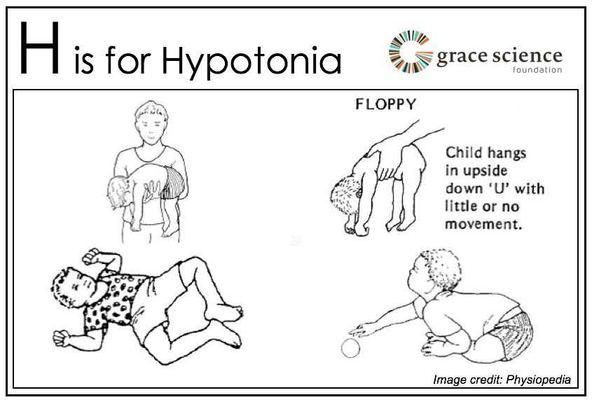 Hypotonia