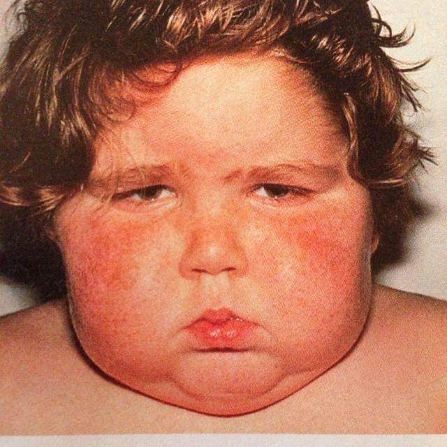 Plethoric Face Lessons From Iatrogenic Cushing Syndrome In Children