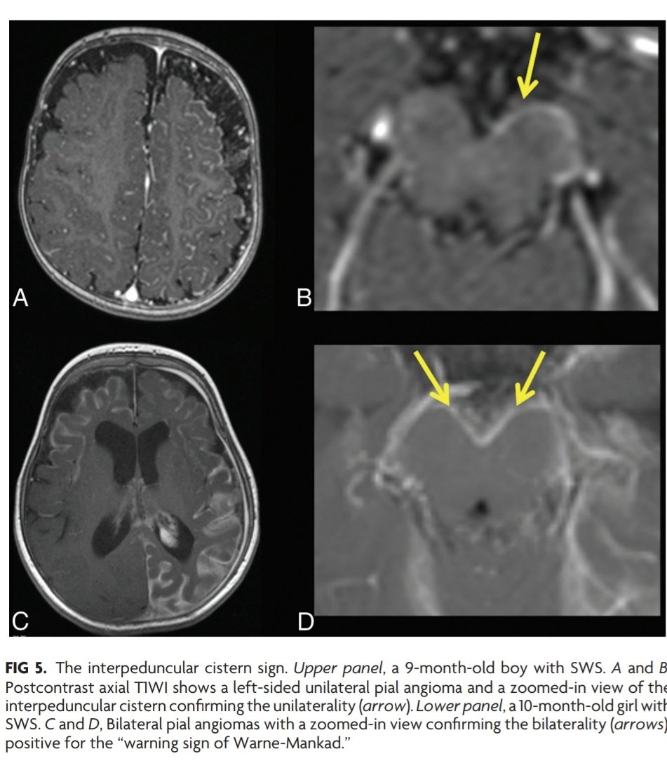 Interpeduncular Cistern