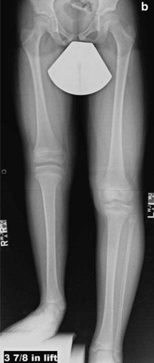 Fibular Hemimelia X Ray