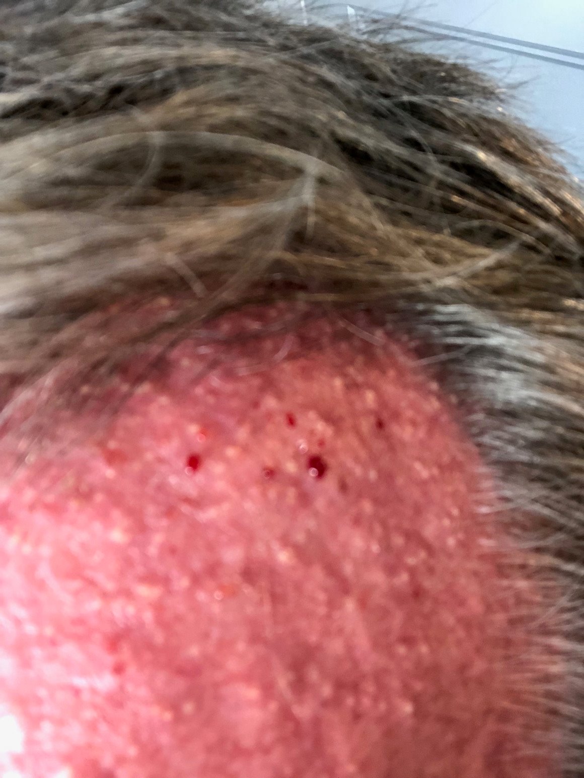 Vectibix Rash