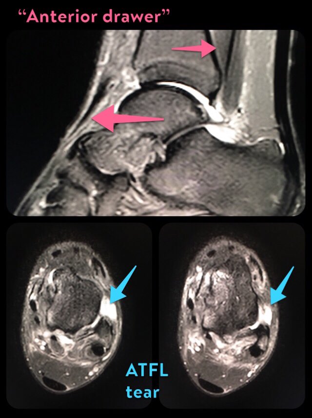 Anterior Talofibular Ligament Mri