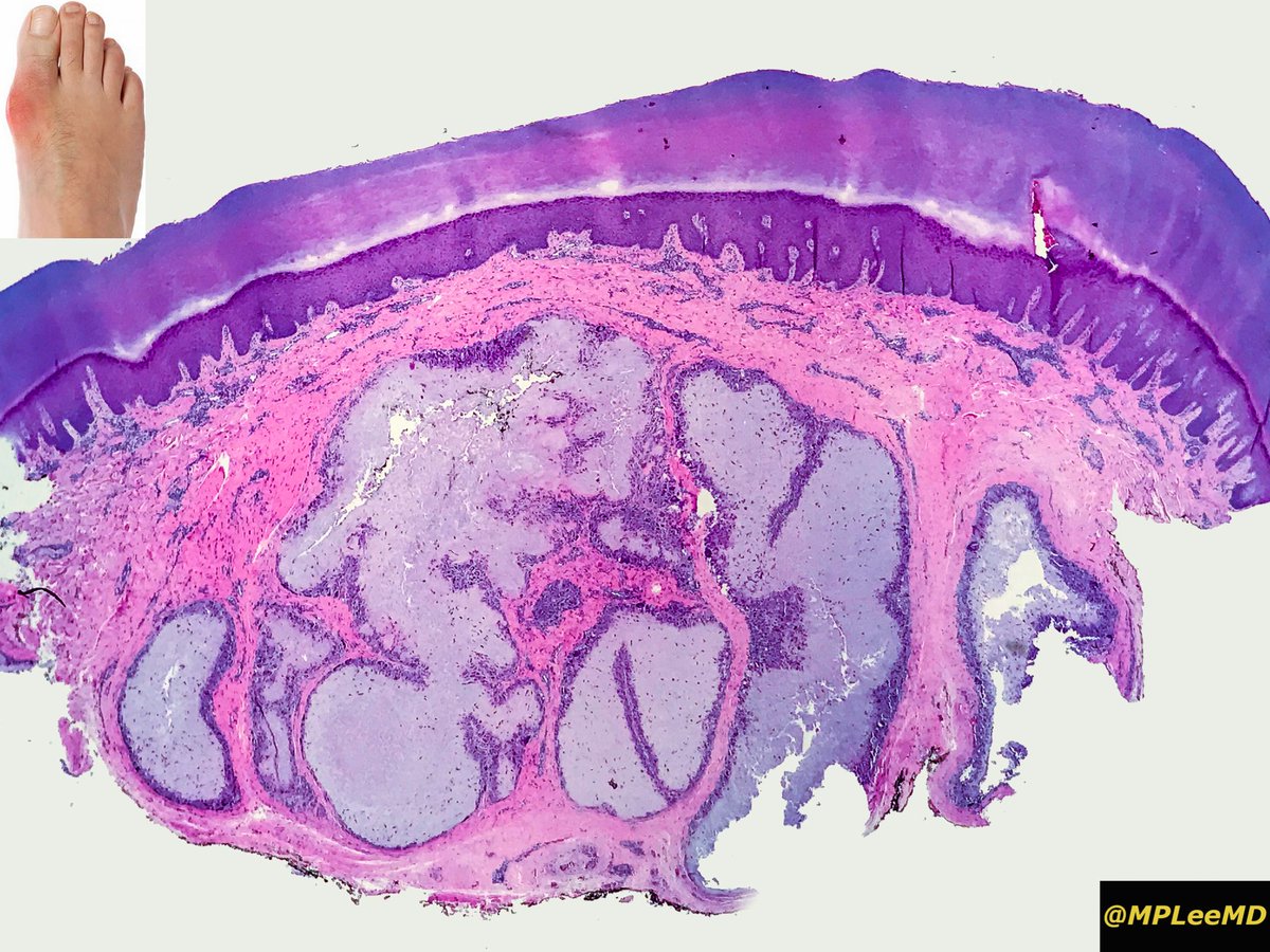 Tophus Histology