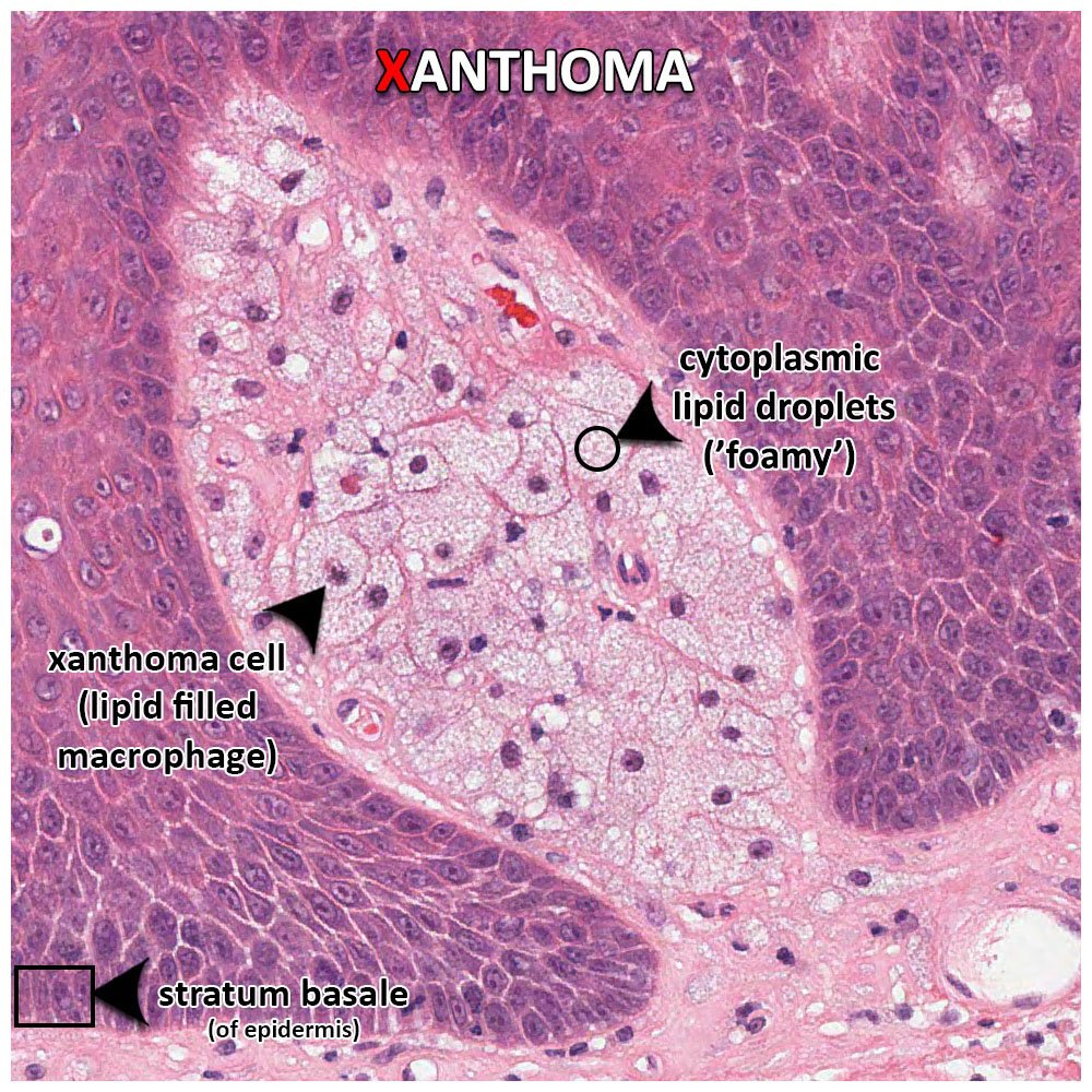 Xanthoma Cells Histological Findings Of An Achilles Xanthoma Showing
