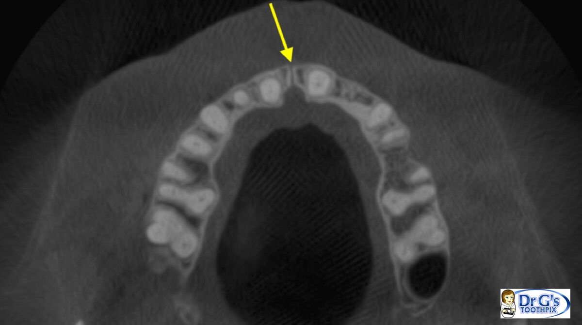 Intermaxillary Suture Radiograph