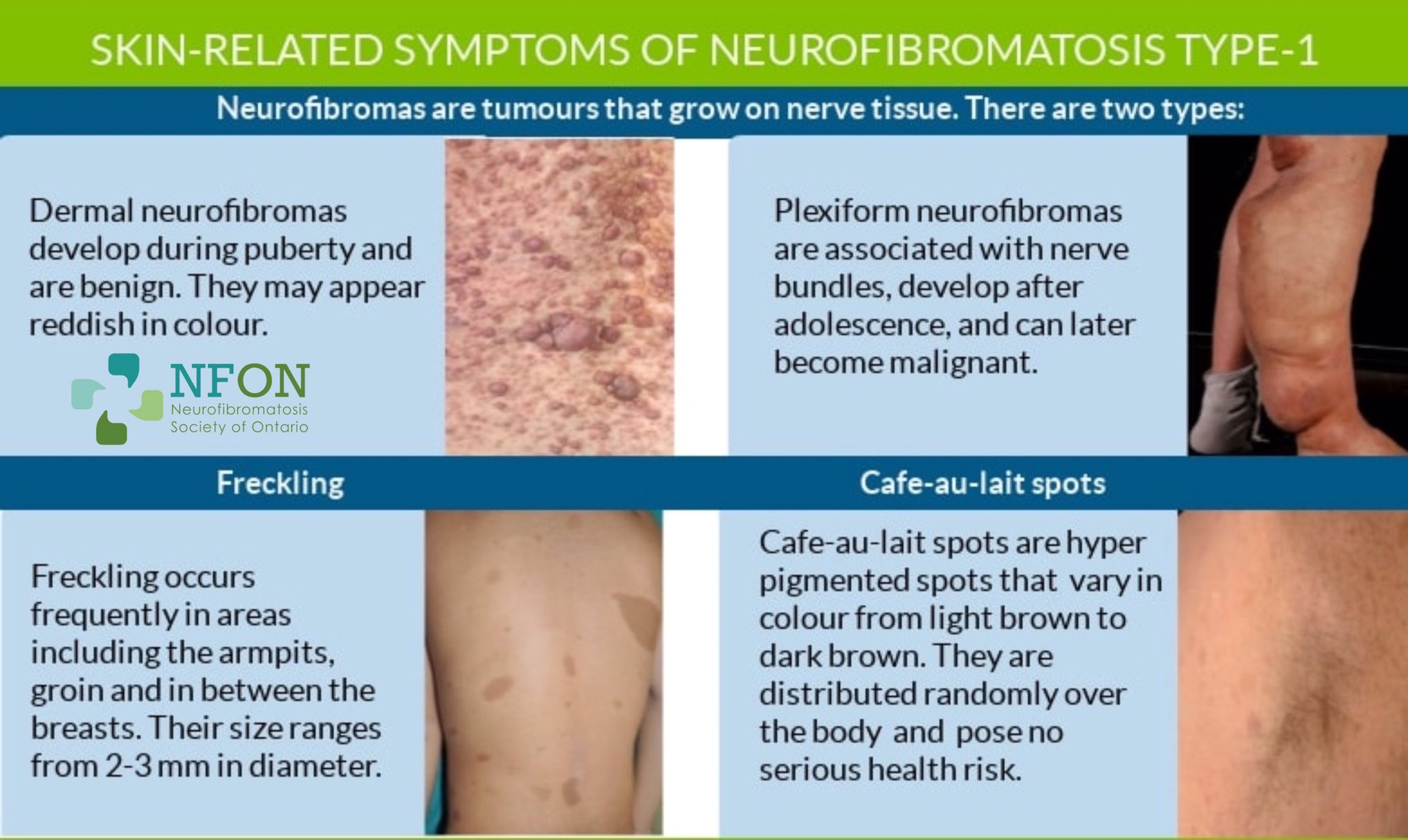 Neurofibromas And Your Skin