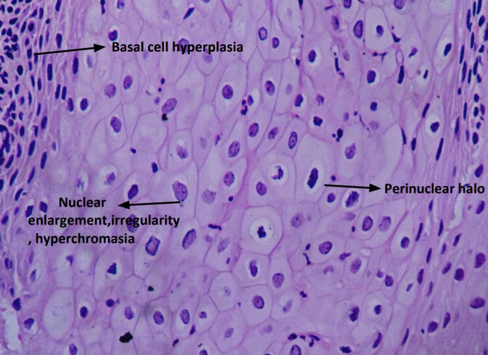 Koilocytes