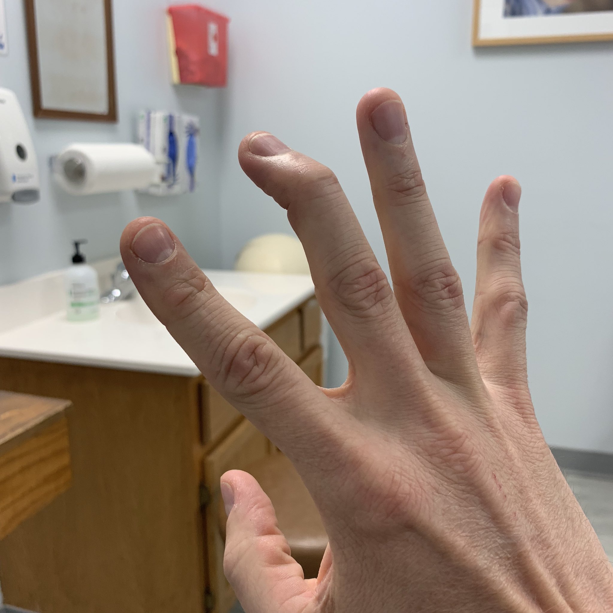 Broken Middle Finger Cast