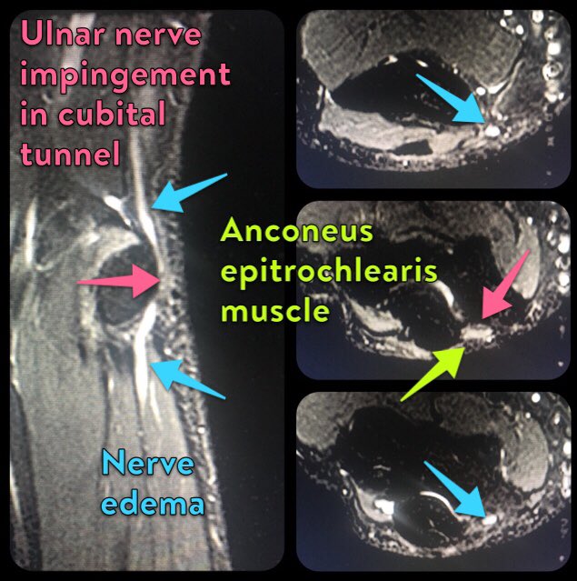 Anconeus Epitrochlearis Muscle