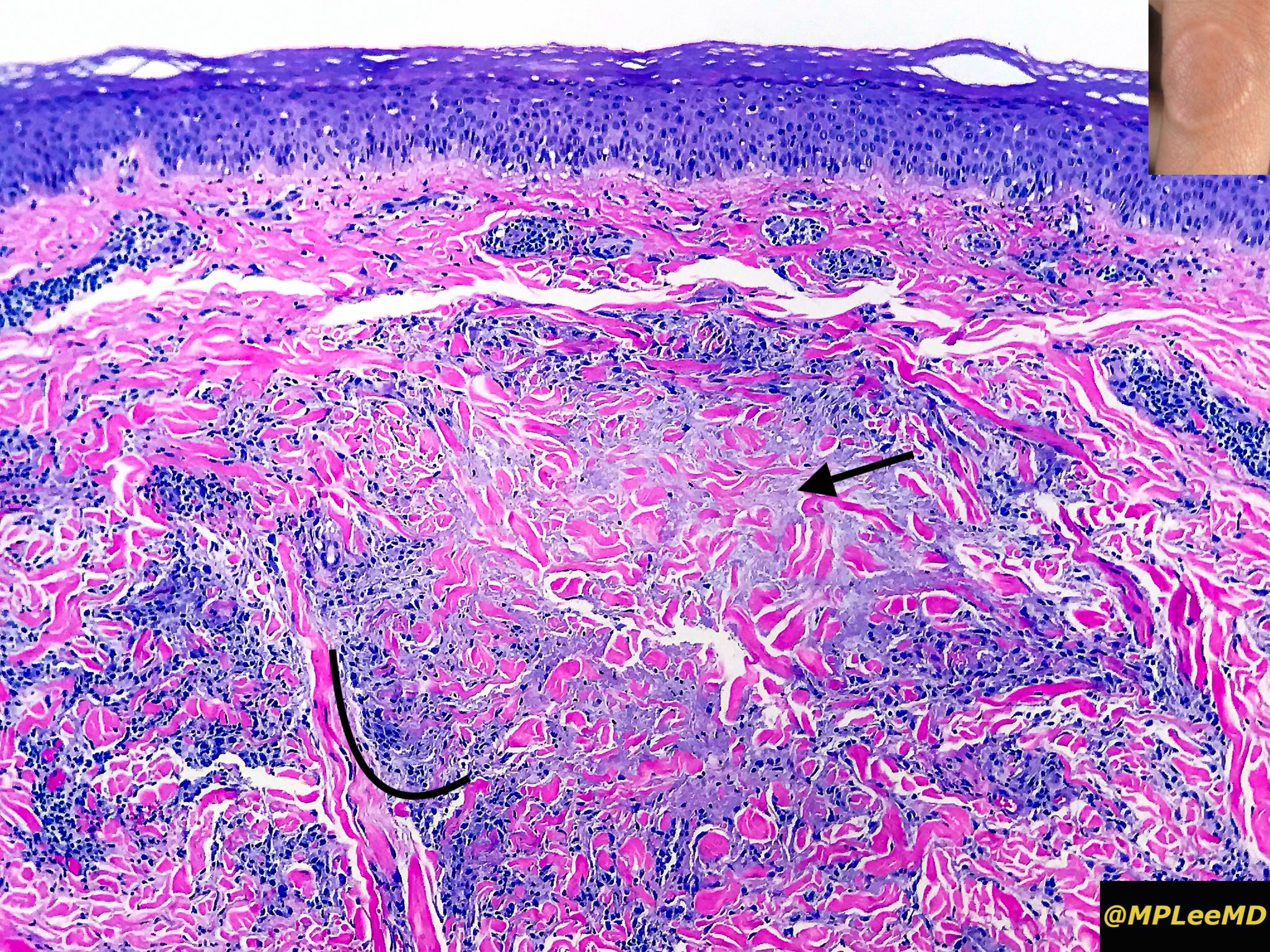 Granuloma Annulare Histopathology